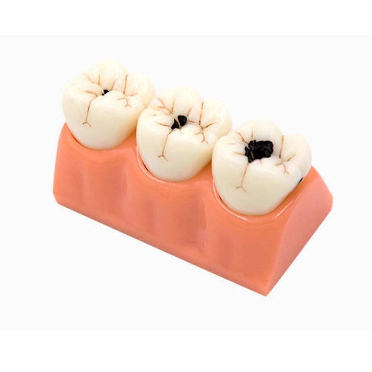 Tooth Decay Model Tooth Lesions Four Times Teeth Comprehensive ...