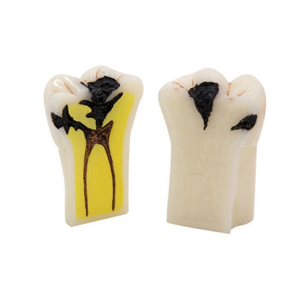 Tooth Decay Model Tooth Lesions Four Times Teeth Comprehensive ...