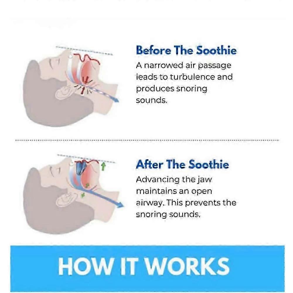 2025 New Honex Anti-Snoring Mouthpiece, Quiet Anti-Snoring Device at ...