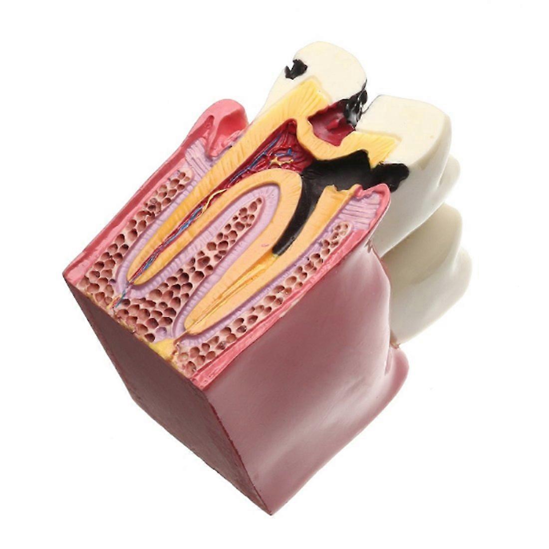 Dental Caries Tooth Model, YOUYA DENTAL Decay Teeth Comparative Study ...