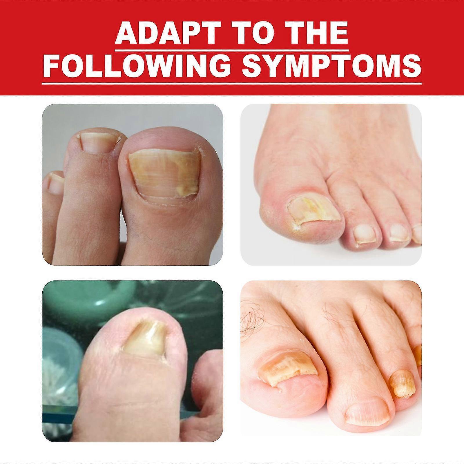 Ingrown Toenail Treatment,nail Growth Treatment,ingrown Toenail Drops ...