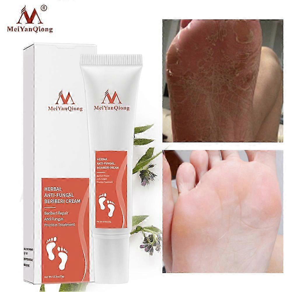 Foot Anti-Inflammatory Cream Anti-Fungal Infection Removal Feet Callus ...