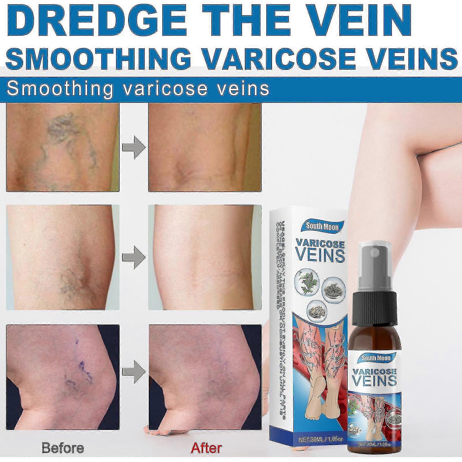 30ml Varicose Vein Massage Spray Smoothing Vascular Lumps Smoothing ...