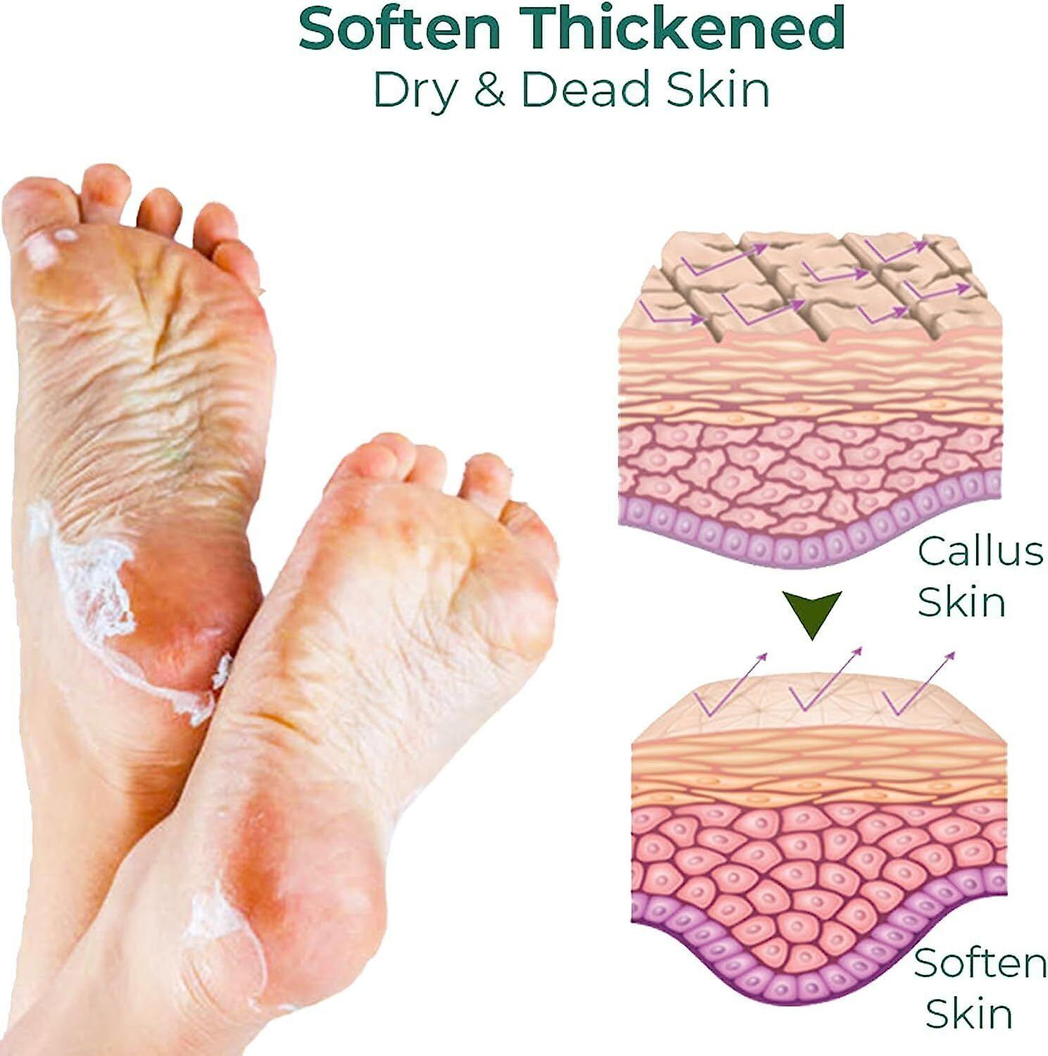 Foot Callus Removal Spray, Foot Heel Callus Remover Spray, Foot Peel ...