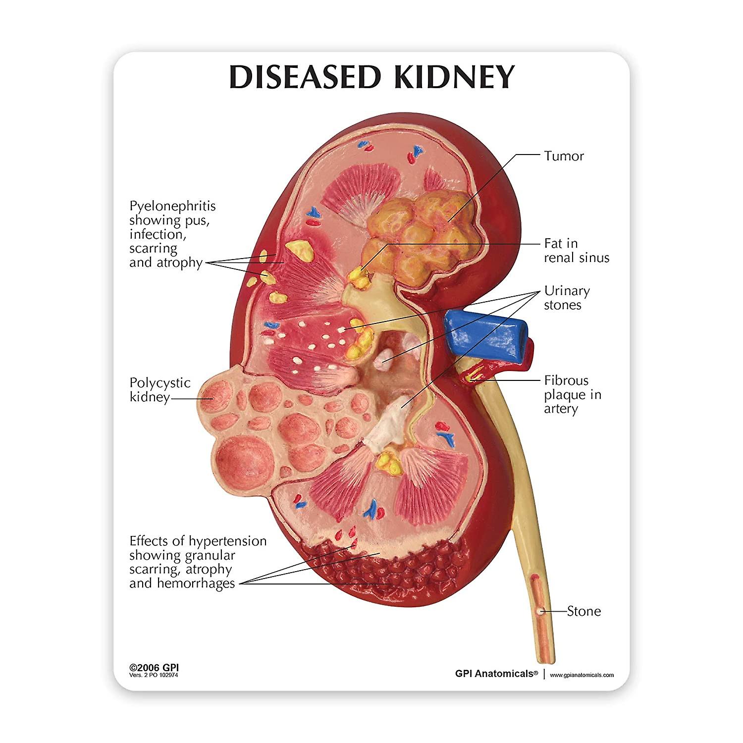Kidney Pathology Model Human Anatomy Pathological Kidney Model For ...