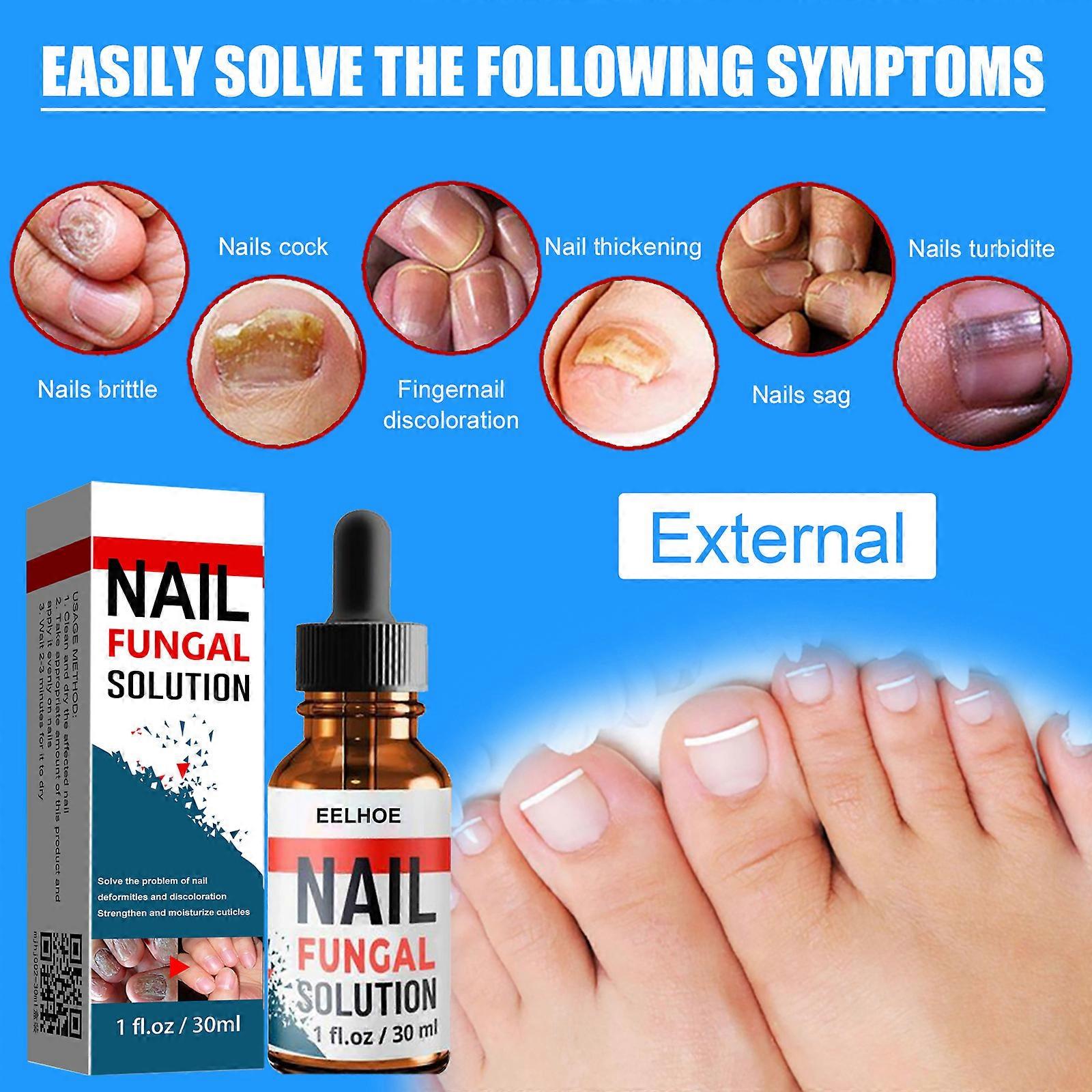 30ml Nail Fungal Treatment Feet Care Essence Nail Foot Care Toe Nail ...