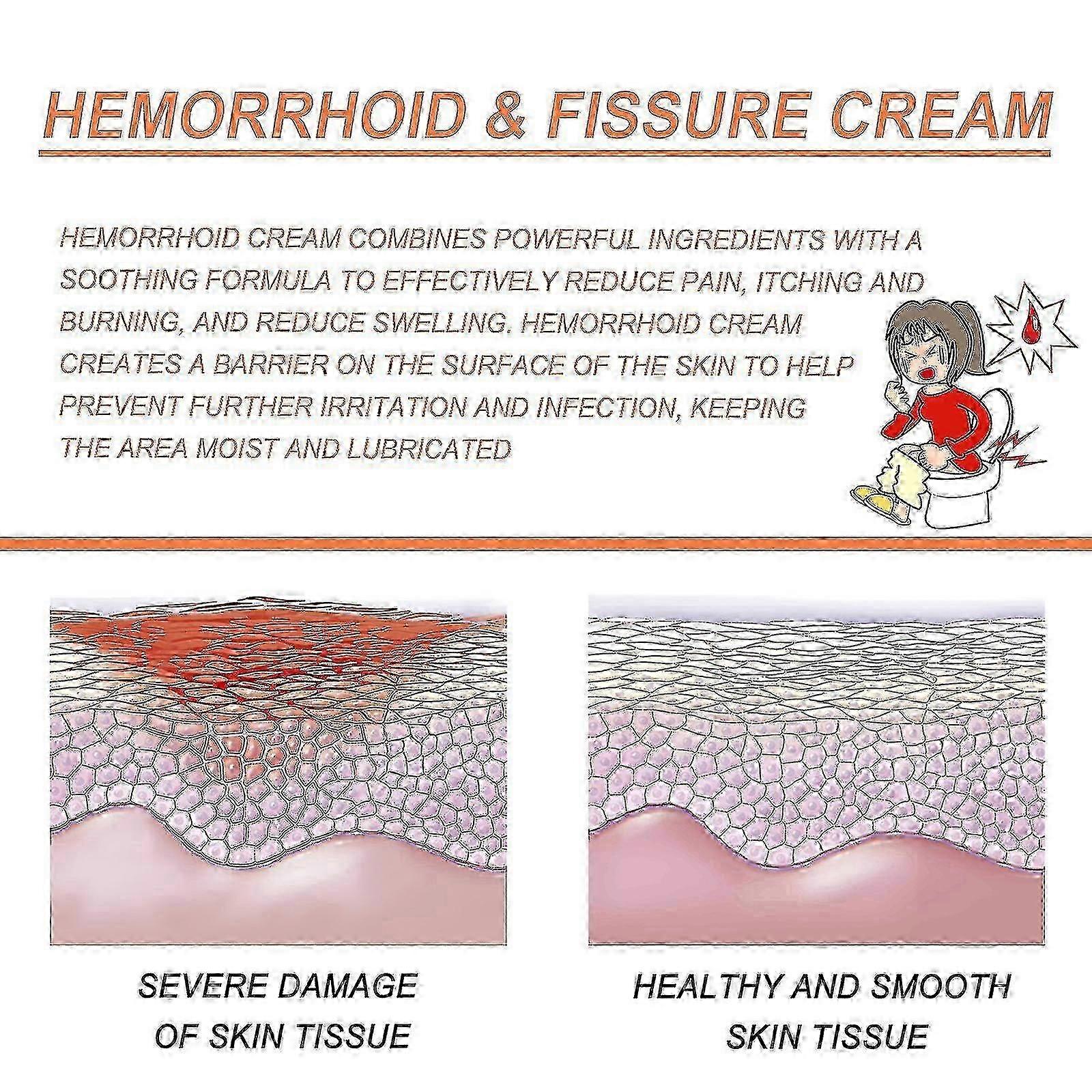 Hemorrhoid Cream Is A Mixture Of Internal And External Swollen Hemorrhoid Balls That Can Be Used ...