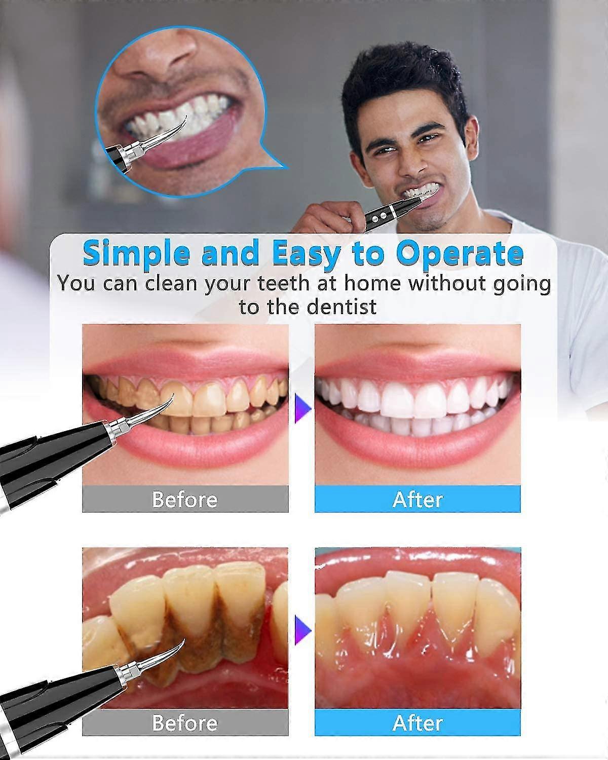 Ultrasonic Teeth Cleaner - Plaque Remover For Removing Teeth Stains ...