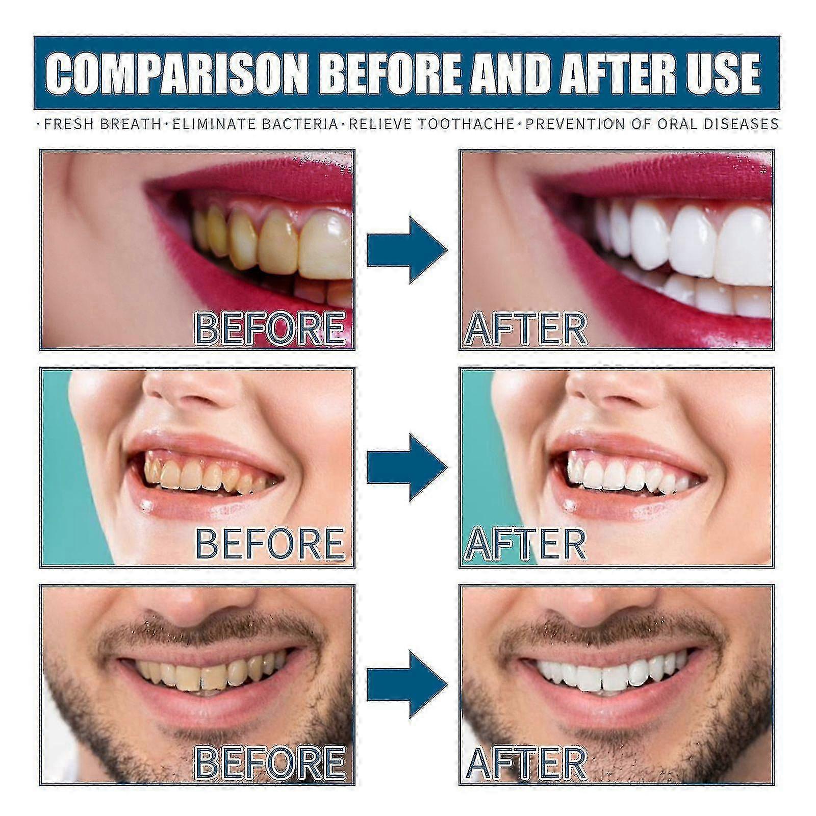 Jaysuing mouthwash removes tooth stains, removes odor and bad breath ...