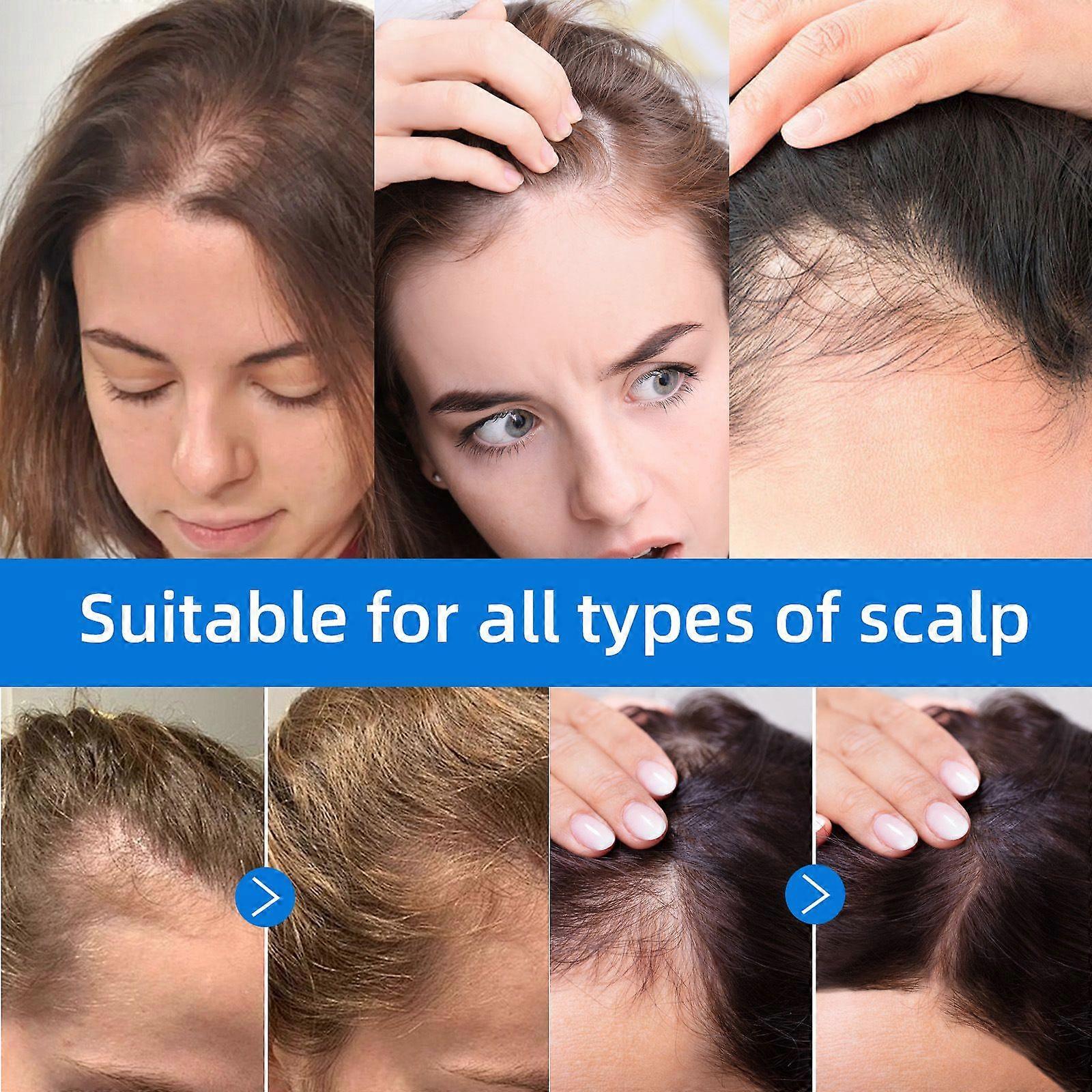 Scalpy Hair Growth Serum for Hair Loss & Thinning | Scalp Treatment for ...
