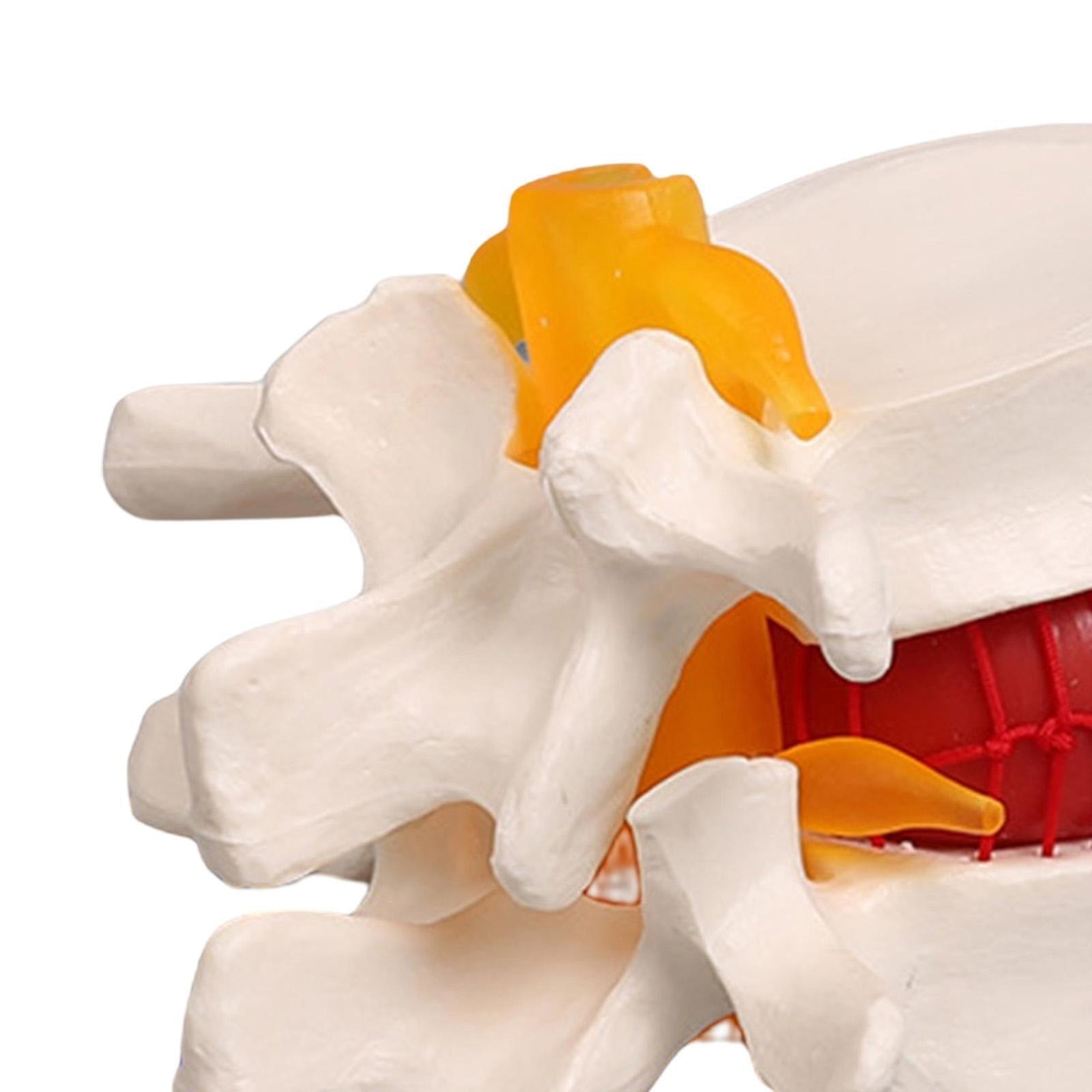 Lumbar Disc Herniation Model Lumbar Spine Model For Learning | Fruugo FR
