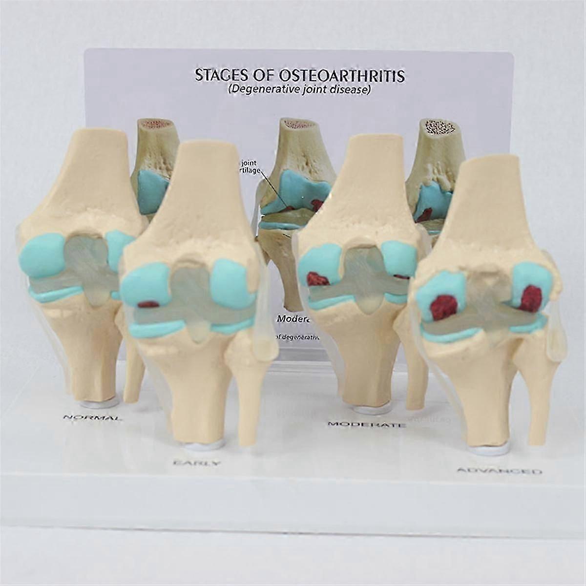 Knee Kit Osteoarthritis Anatomy Model with Educational Key Card 4 Stage ...