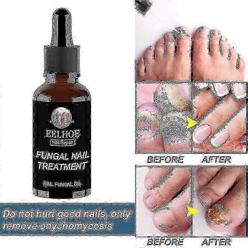Powerful Nail Fungus Care Repair Liquid Professional Cuticle Oi | Fruugo UK