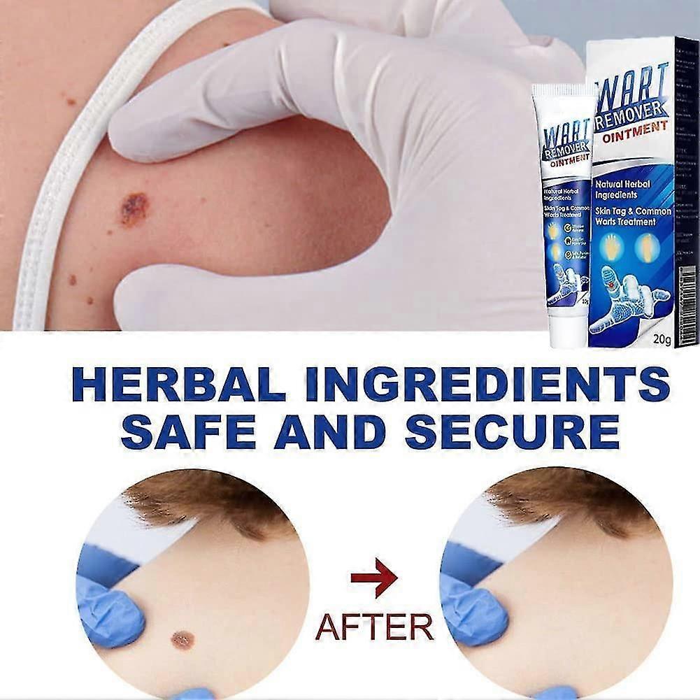 Wartsoff Instant Blemish Removal Cream, Gentle Safe Natural Extract ...