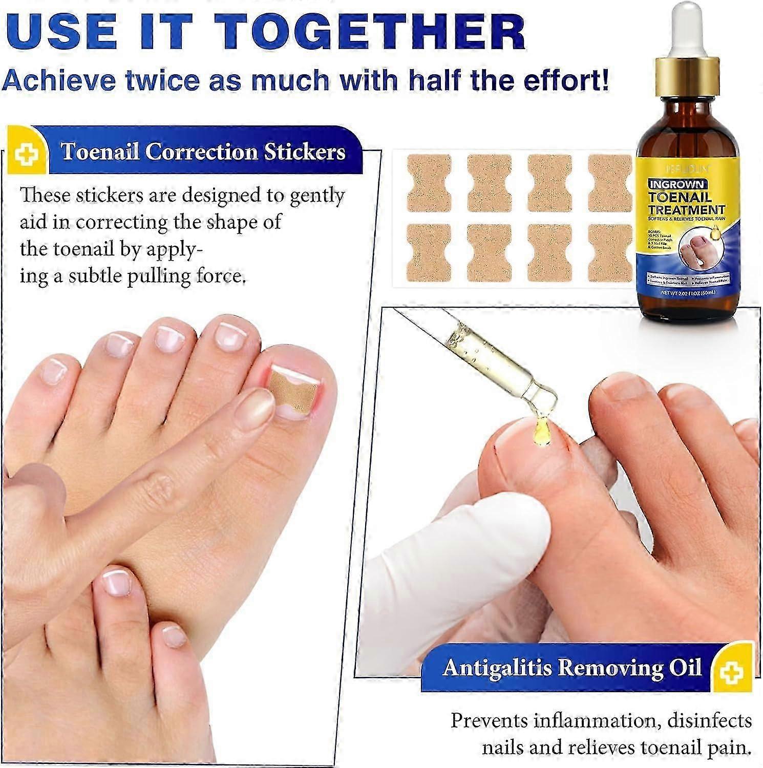 Ingrown Toenail Treatment 60ml, Softener Ingrown Toenail for Easy ...