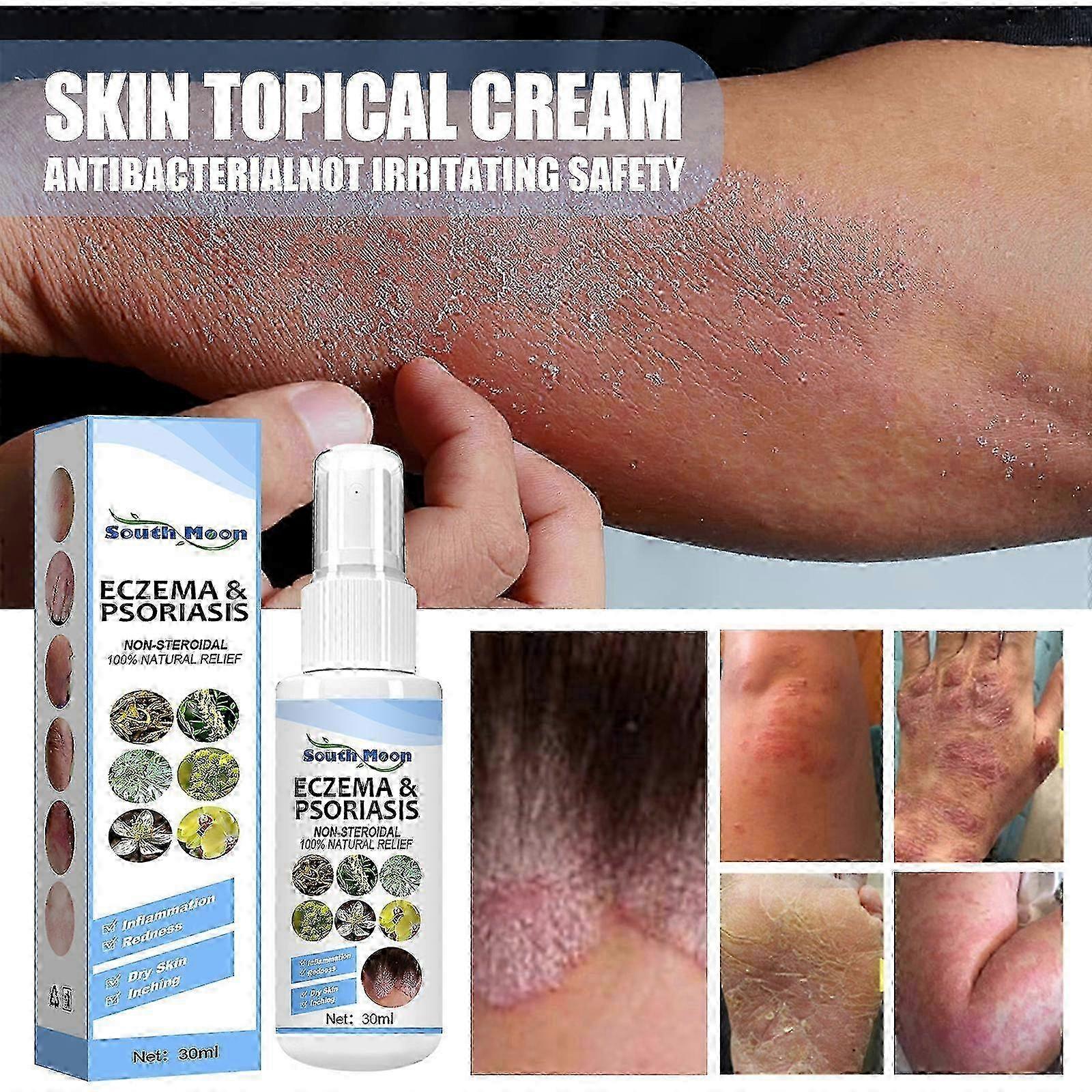 2pcs Ringworm Cream - Treats Stubborn Ringworm Infections, Fights ...