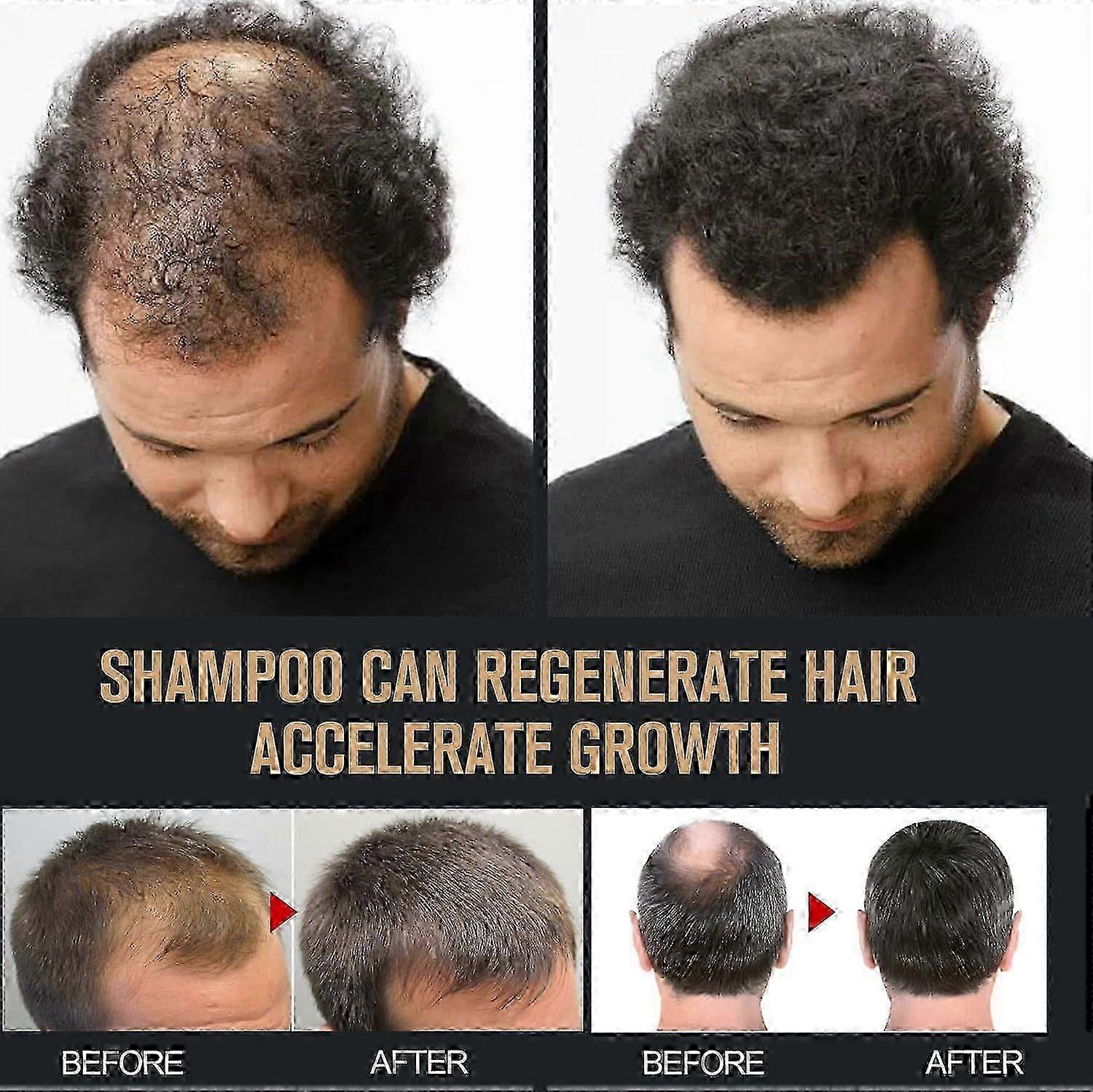Root Activator Shampoo, Hair Regrowth Shampoos, Hair Loss Treatment ...