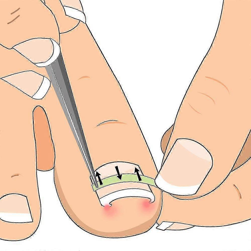 Ingrown Toenail Pedicure Tool 10pcs/ Straightening Clip Curved Bs Brace ...