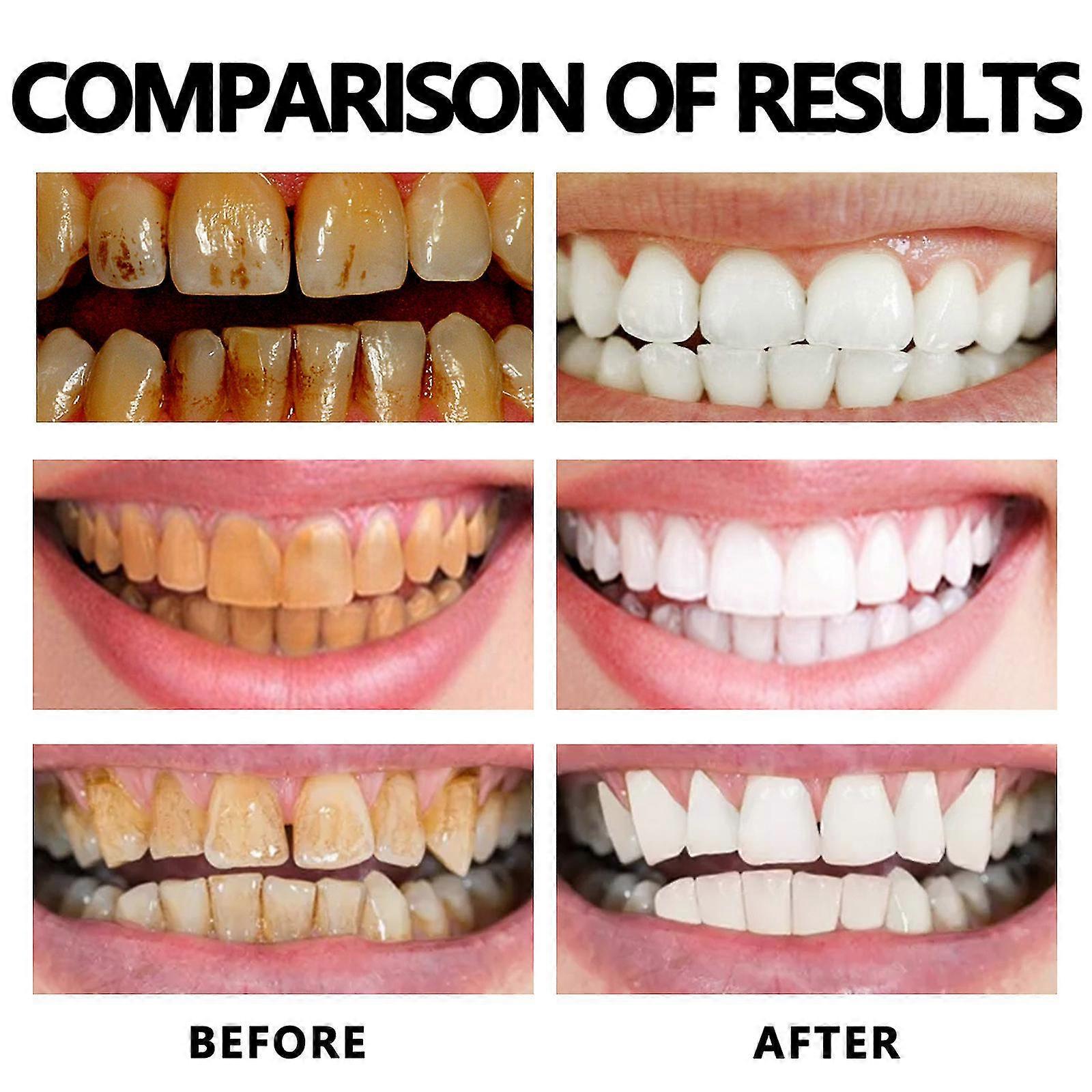 Gum Regrowth Foam, Gum Treatment Foam, Anti-Inflammatory, Gum Tissue ...