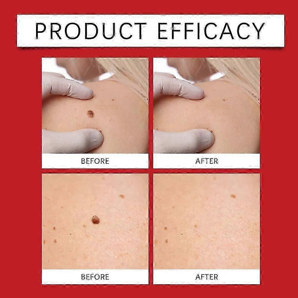 Microneedles Botanical Skin Appendage Removal Patch, Skin Patch for ...