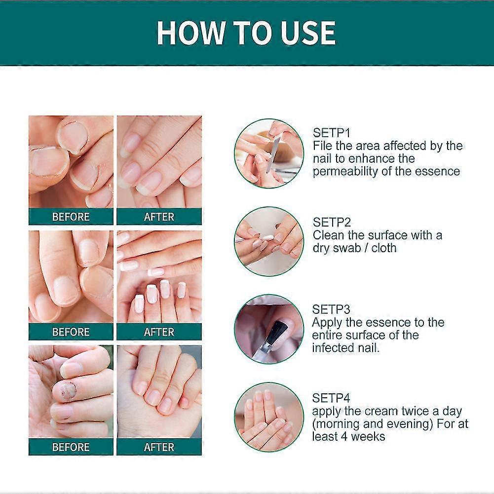 2pcs Fungal Nail Treatment For Toenails Extra Strong-nail Fungus ...