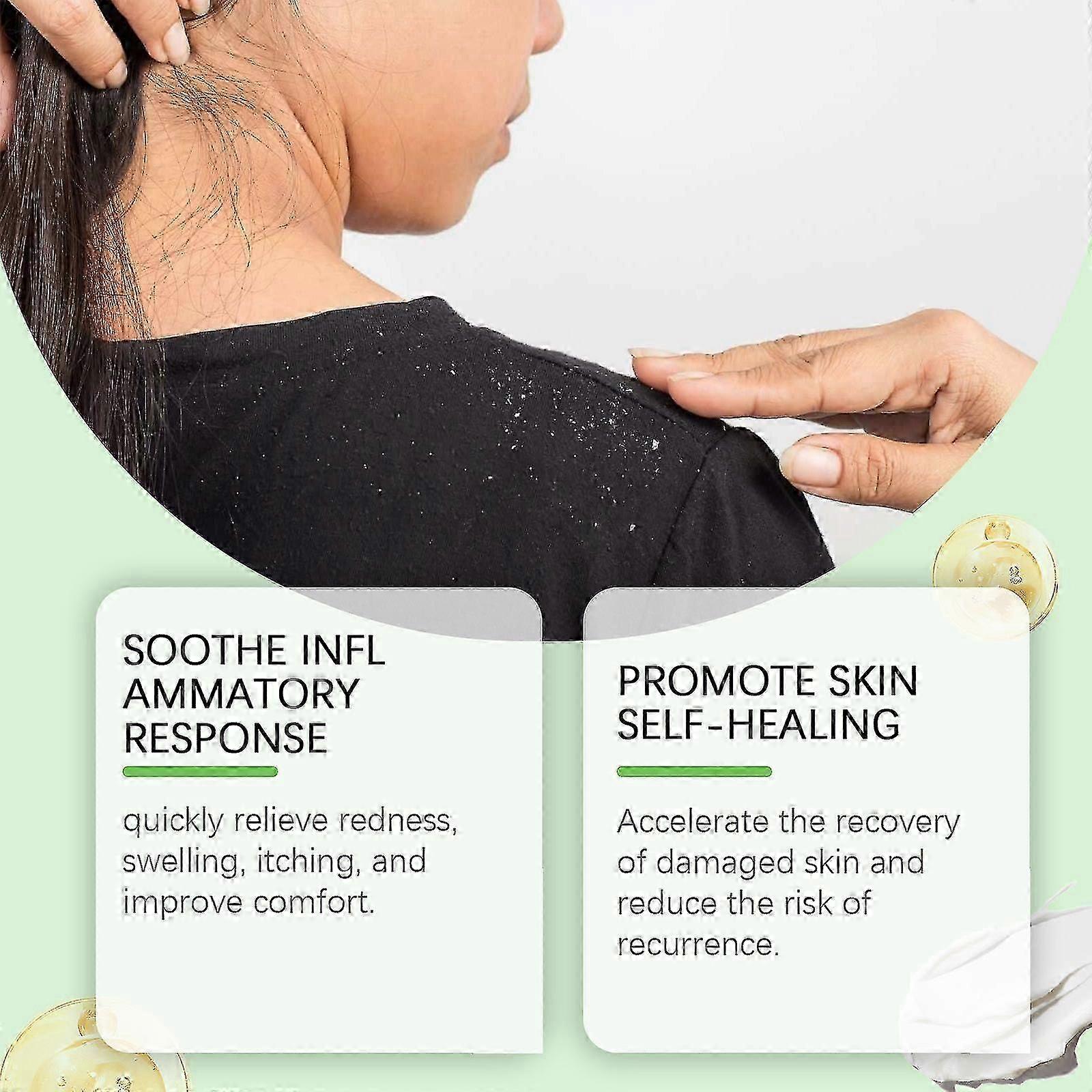 Seborrheic Dermatitis Cream, Fast Acting Seborrheic Dermatitis Scalp Treatment, Gives Comfort ...