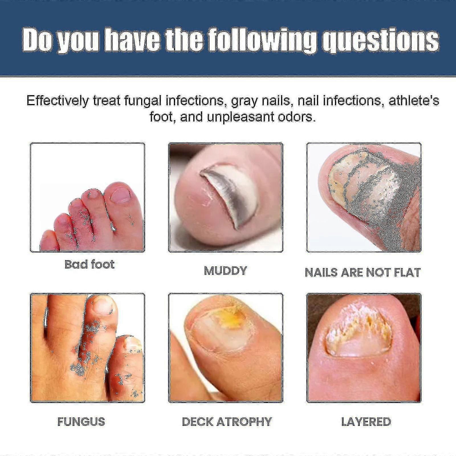 Gray Nail Foot Spray, Nail Fungus Foot Spray, Athlete Foot Treatment ...