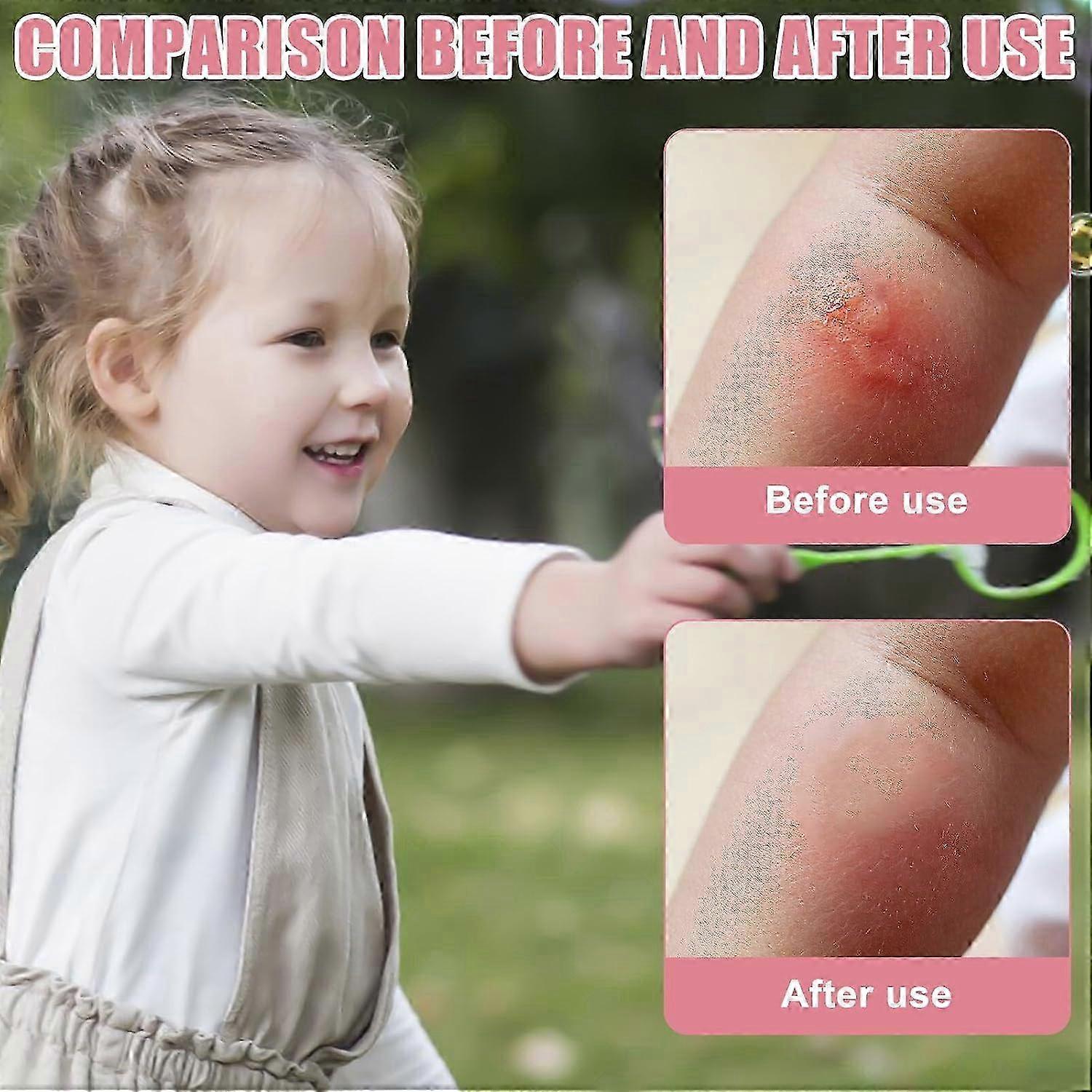 Insect Bite Healer, Electronic Bite Healer, Mosquito Bite Heat Pen ...