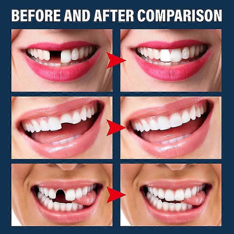Temporary Resin Tooth Repair Glue Shapeable Falseteeth Gaps Filling ...