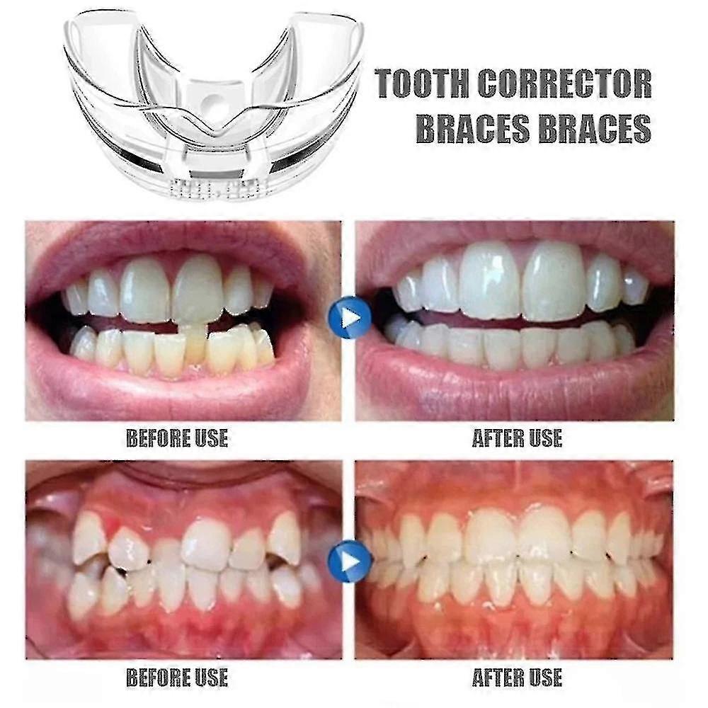 Dental Orthodontic Teeth Corrector Silicone Braces Retainer Straighten ...