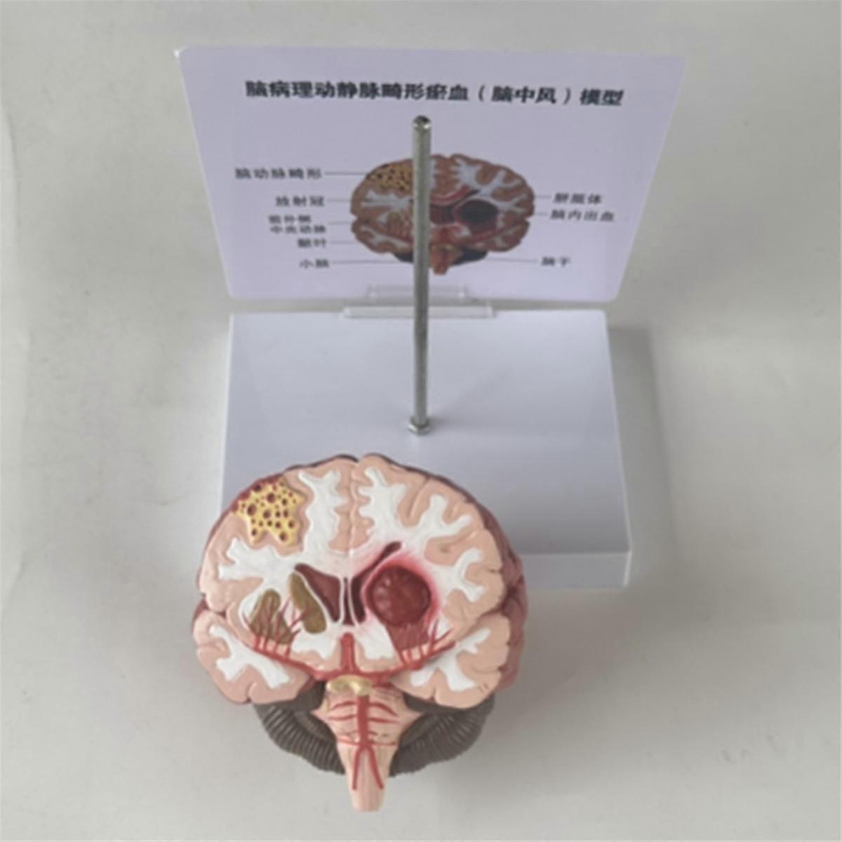 Human Brain Disease Model - Brain Pathology Brainstem Hemorrhage ...