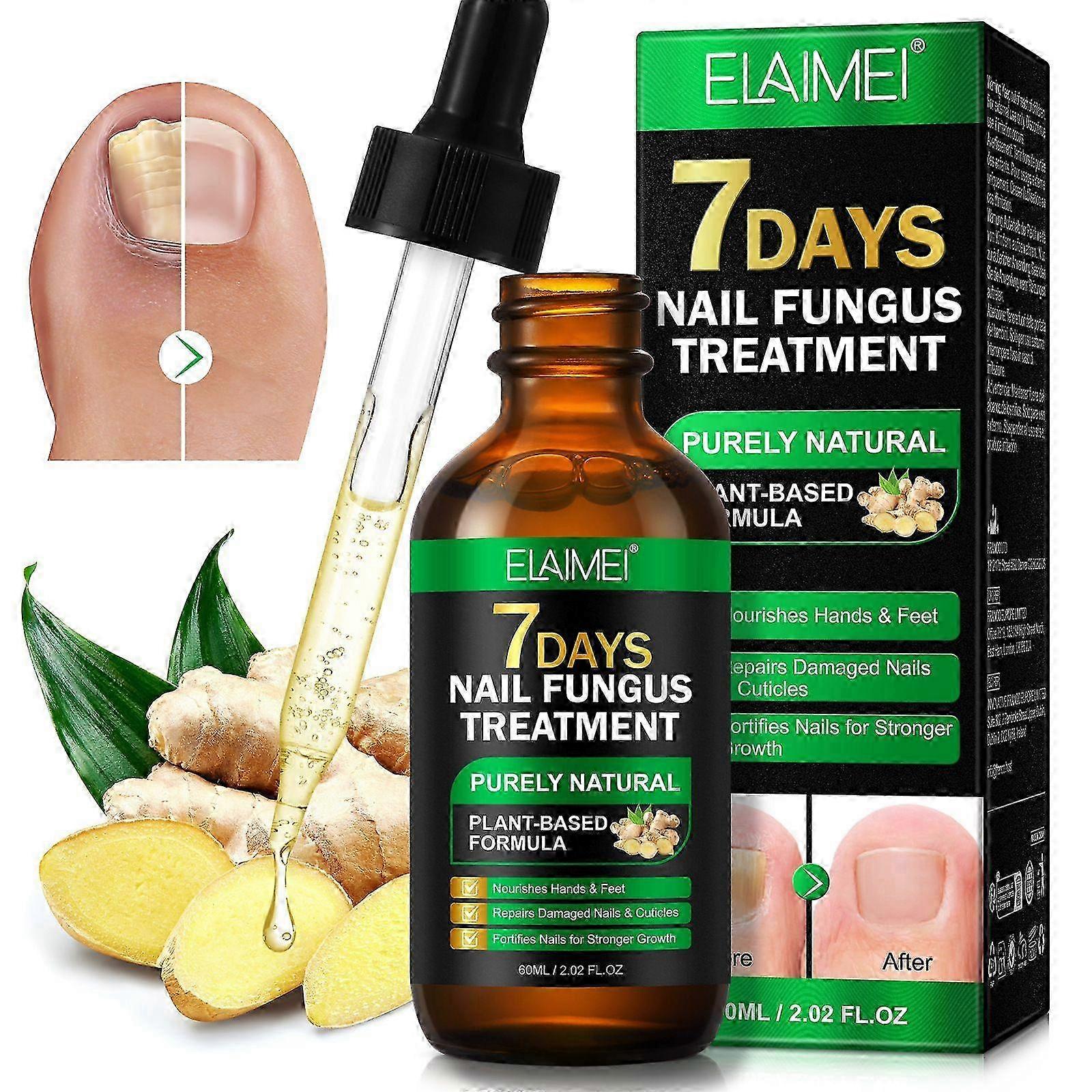 Nail Fungus Treatment, Ginger Nail Fungus Treatment, Toenail Cuticle ...