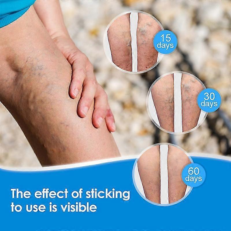 60/80pcs 2types Of Varicose Veins Patch Treat Thigh Phlebitis ...
