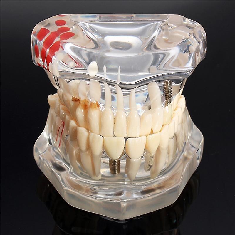Implant Dental Disease Teeth Model With Restoration Bridge, Tooth ...