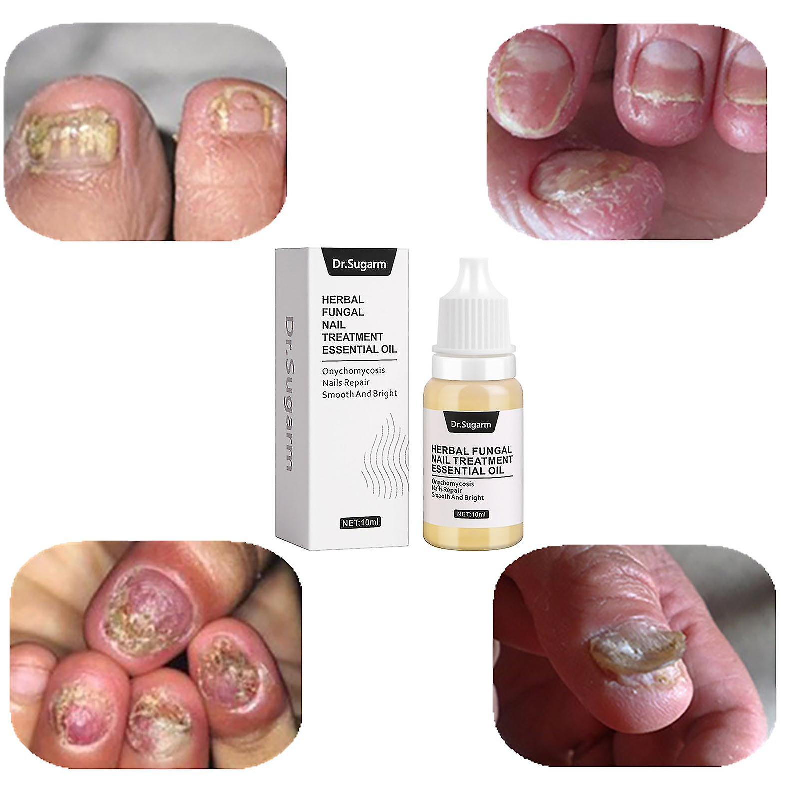 Nail Repair Liquid Toenail Treatment To Prevent Nail Damage To Nails ...