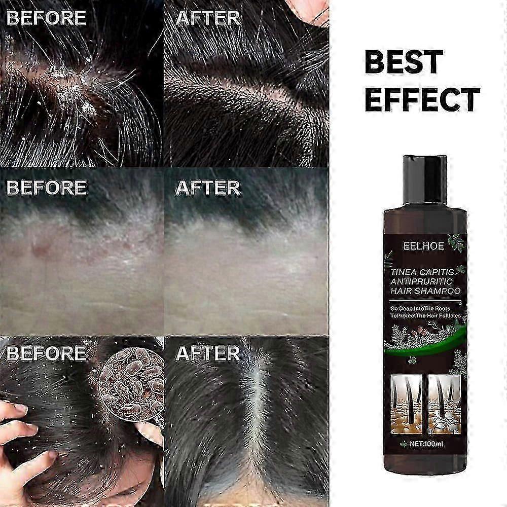 100ML Anti-Dandruff Anti-Itch Shampoo for Itchy Scalp Care, Cleansing ...