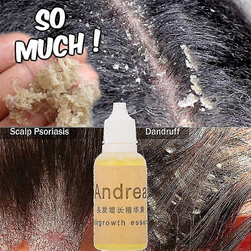 Natural Anti Dandruff Essential Oils Fast Get Rid Of Anti Dandruff Hair ...
