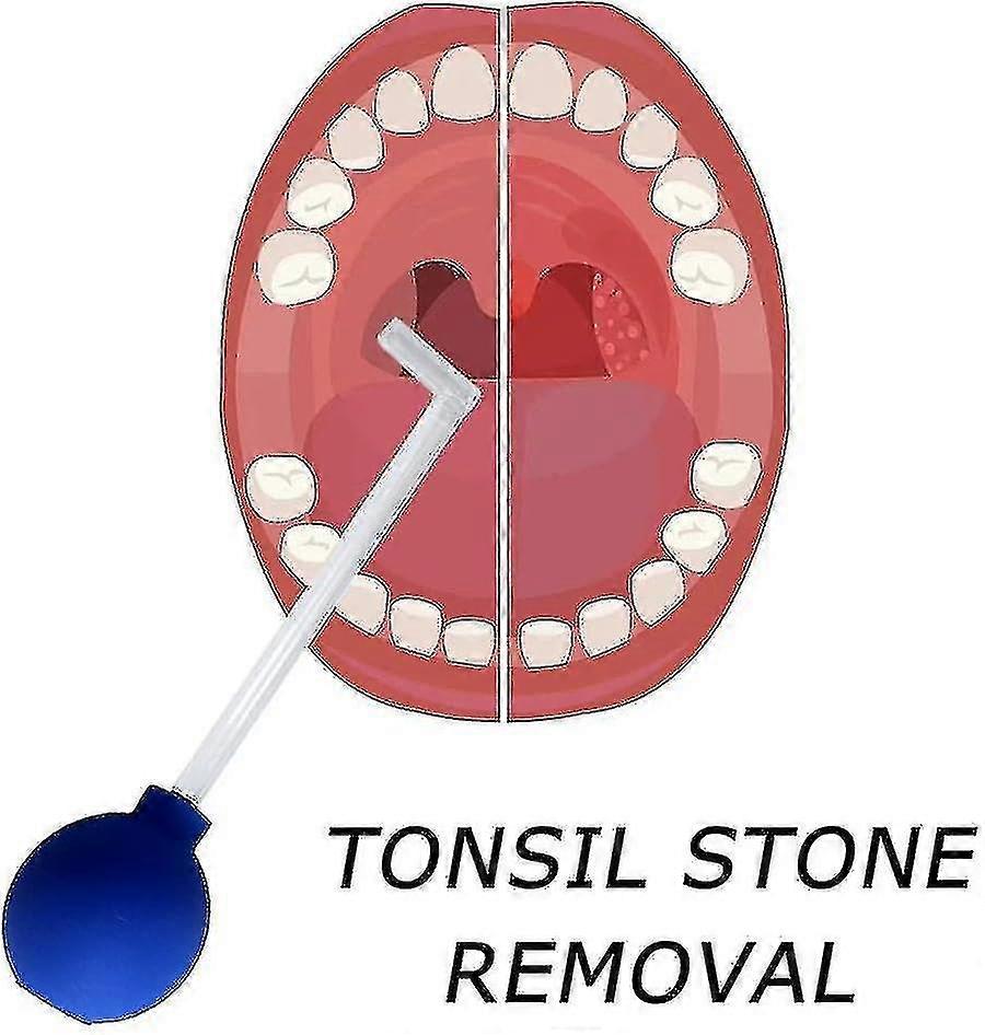 Tonsil Stone Remover Vacuum, Tonsil Stone Removal Kit Tool Tonsil Stone ...