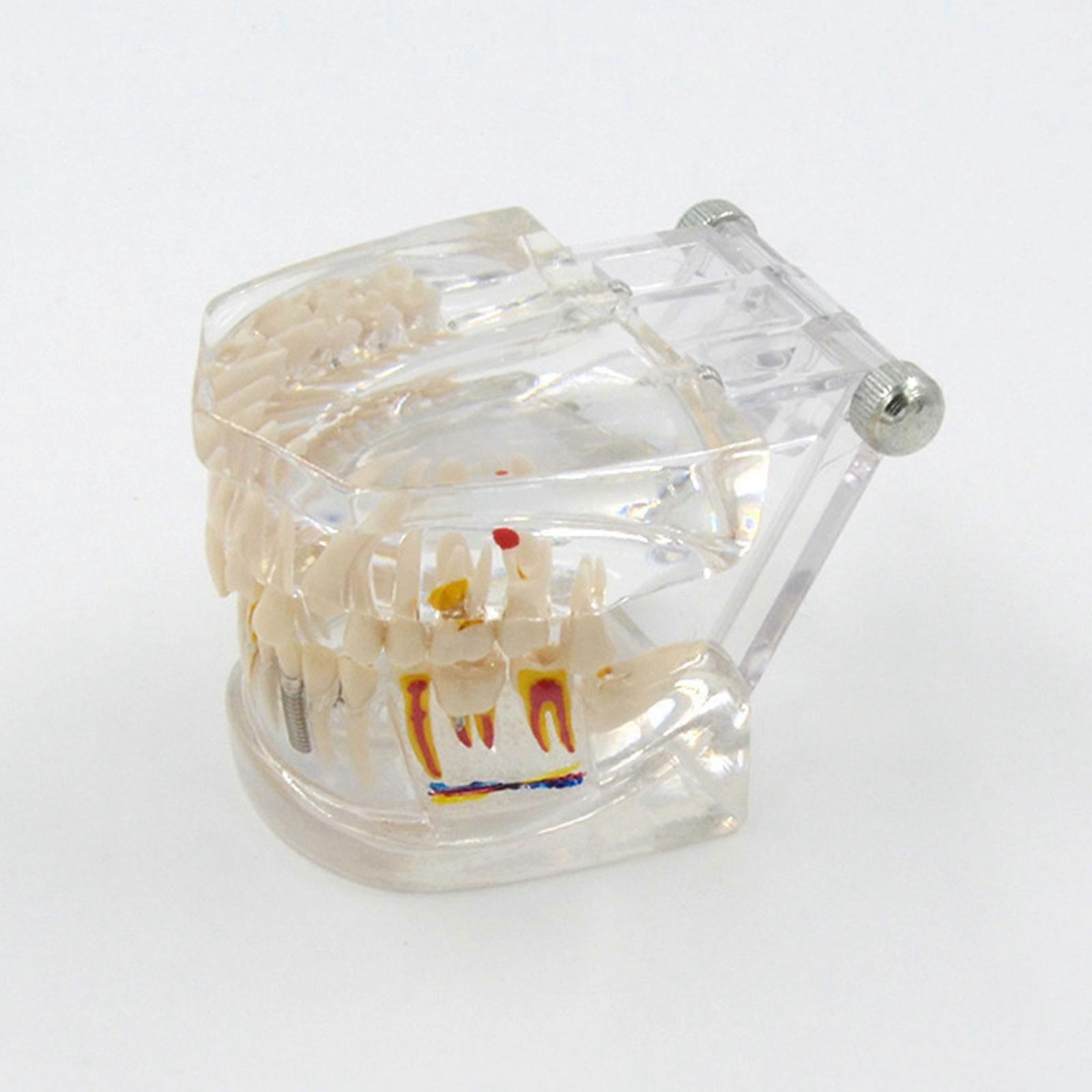 Transparent Dental Implant Model Removable Teeth Portable Disease Teeth ...