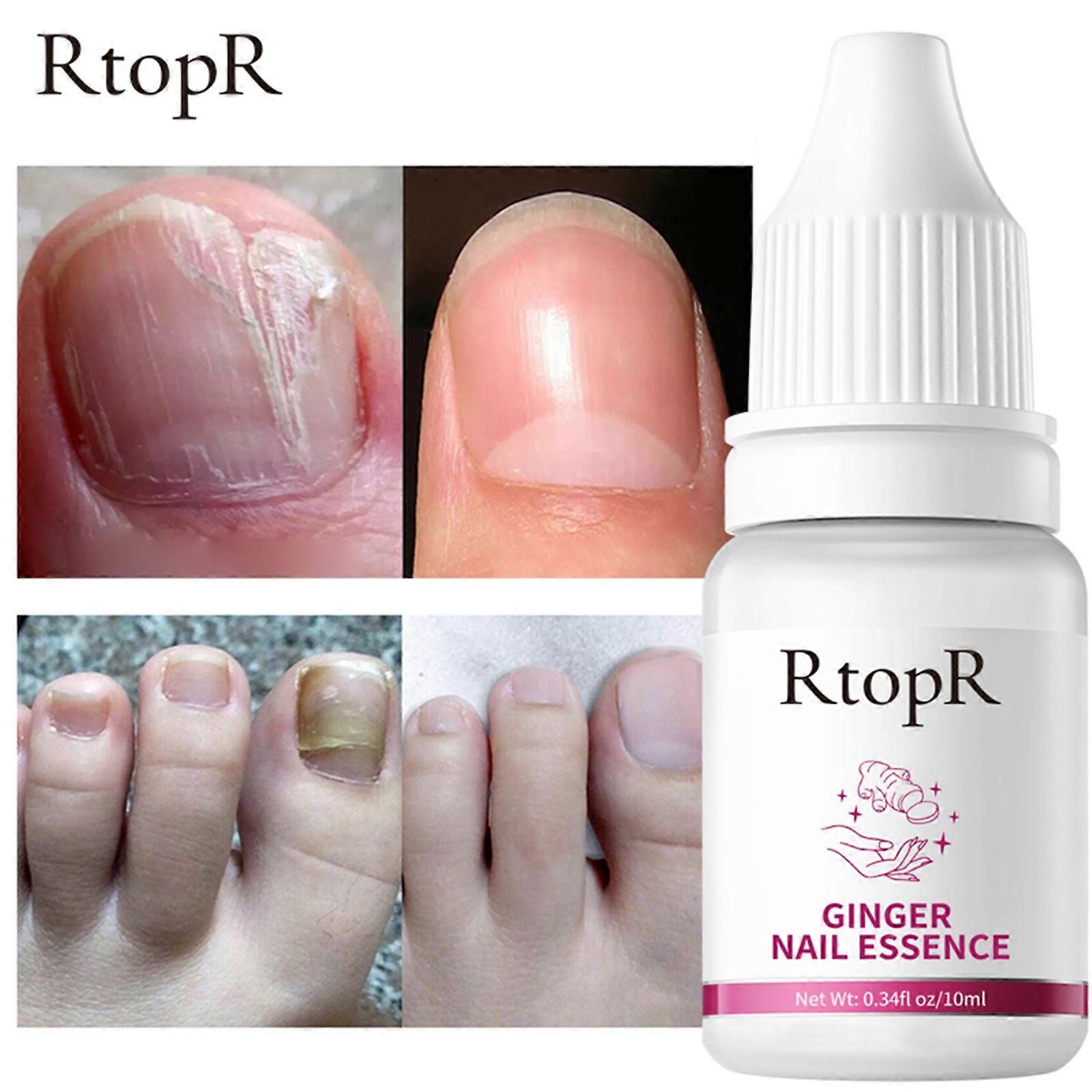 RtopR Ginger Nail Treat Ment Nail Toe Repair 10ml | Fruugo UK
