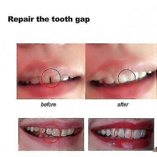 Denture Solid Glue Resin Denture Adhesive Teeth Restoration Kit | Fruugo UK