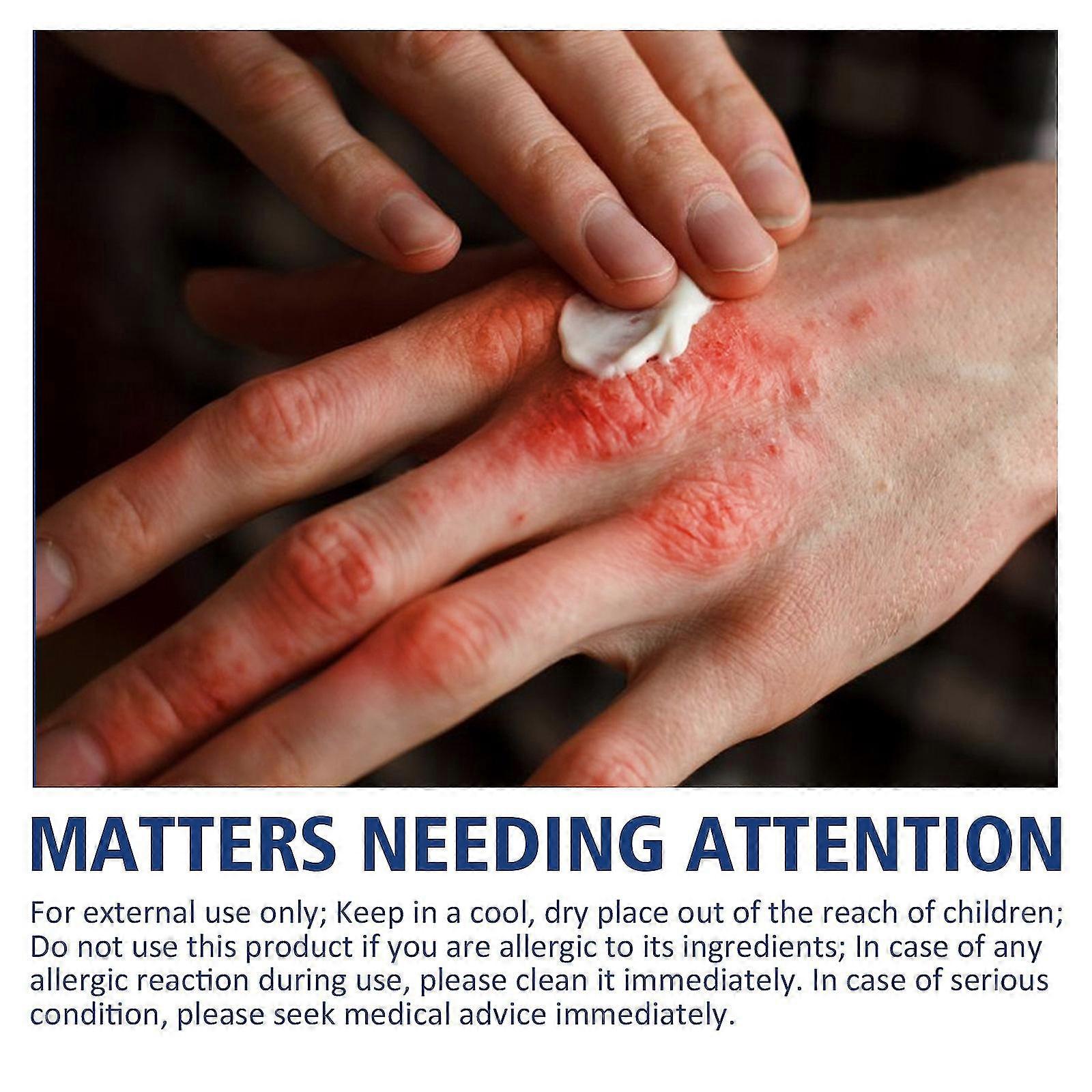 30ML Chilblain Cream Anti-cracking Frostbite Moisturiser Deep ...