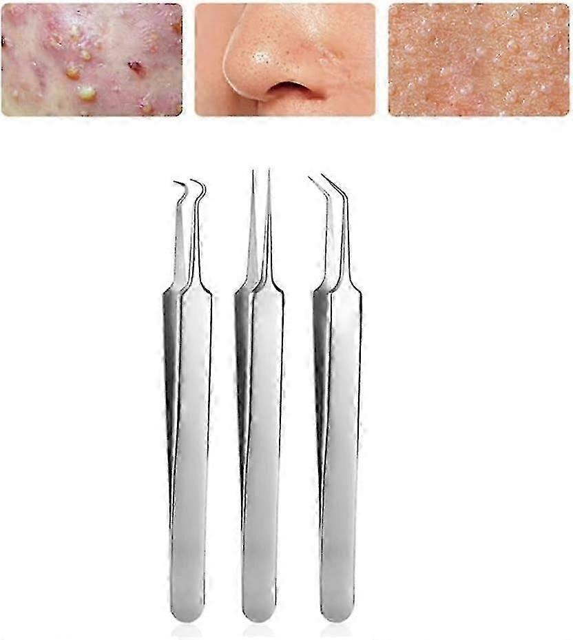 3 piece blackhead removal clip8.7cm, stainless steel beveled acne clip ...