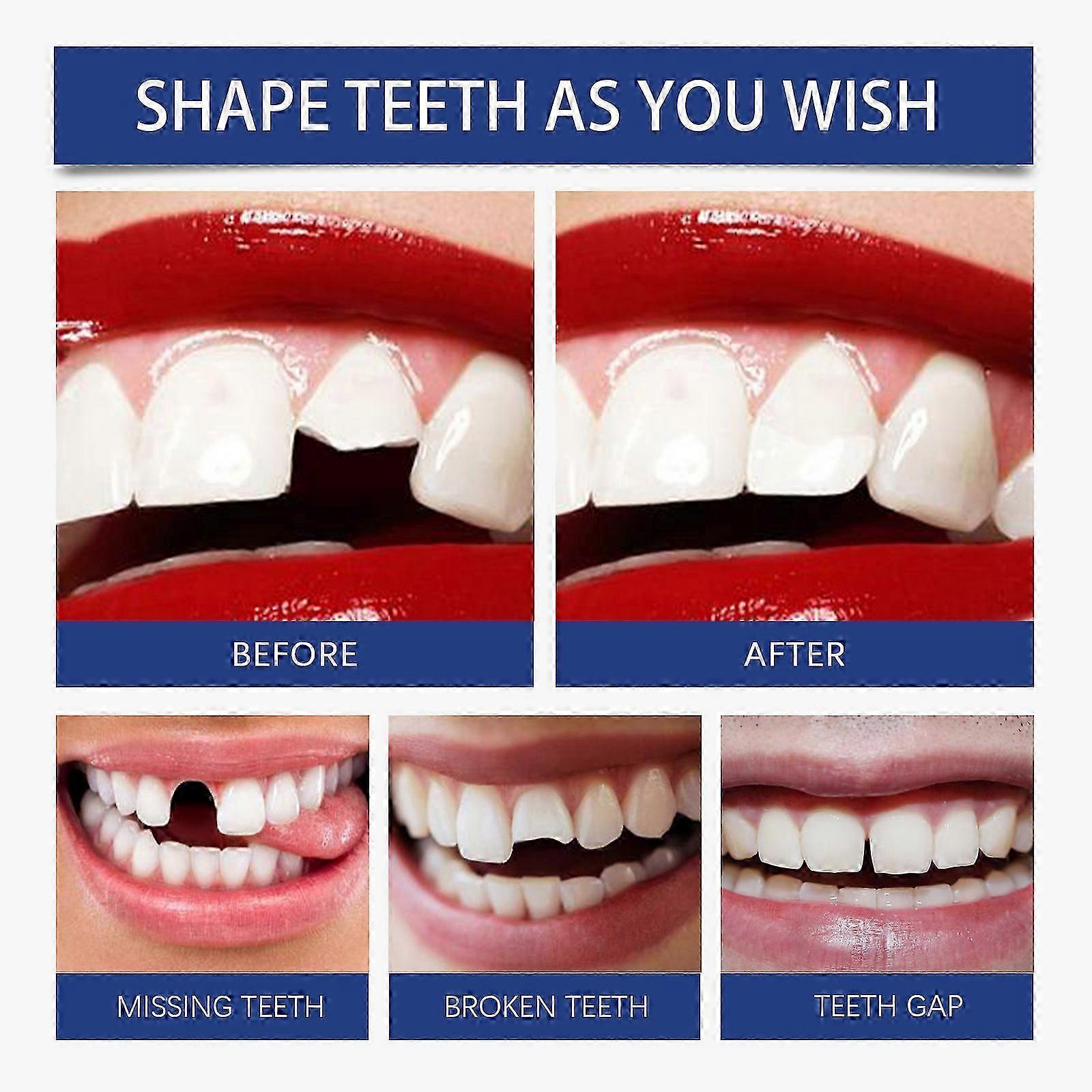 Tooth Repair Kit Temporary Tooth Filling Repair Beads Tooth Repair ...