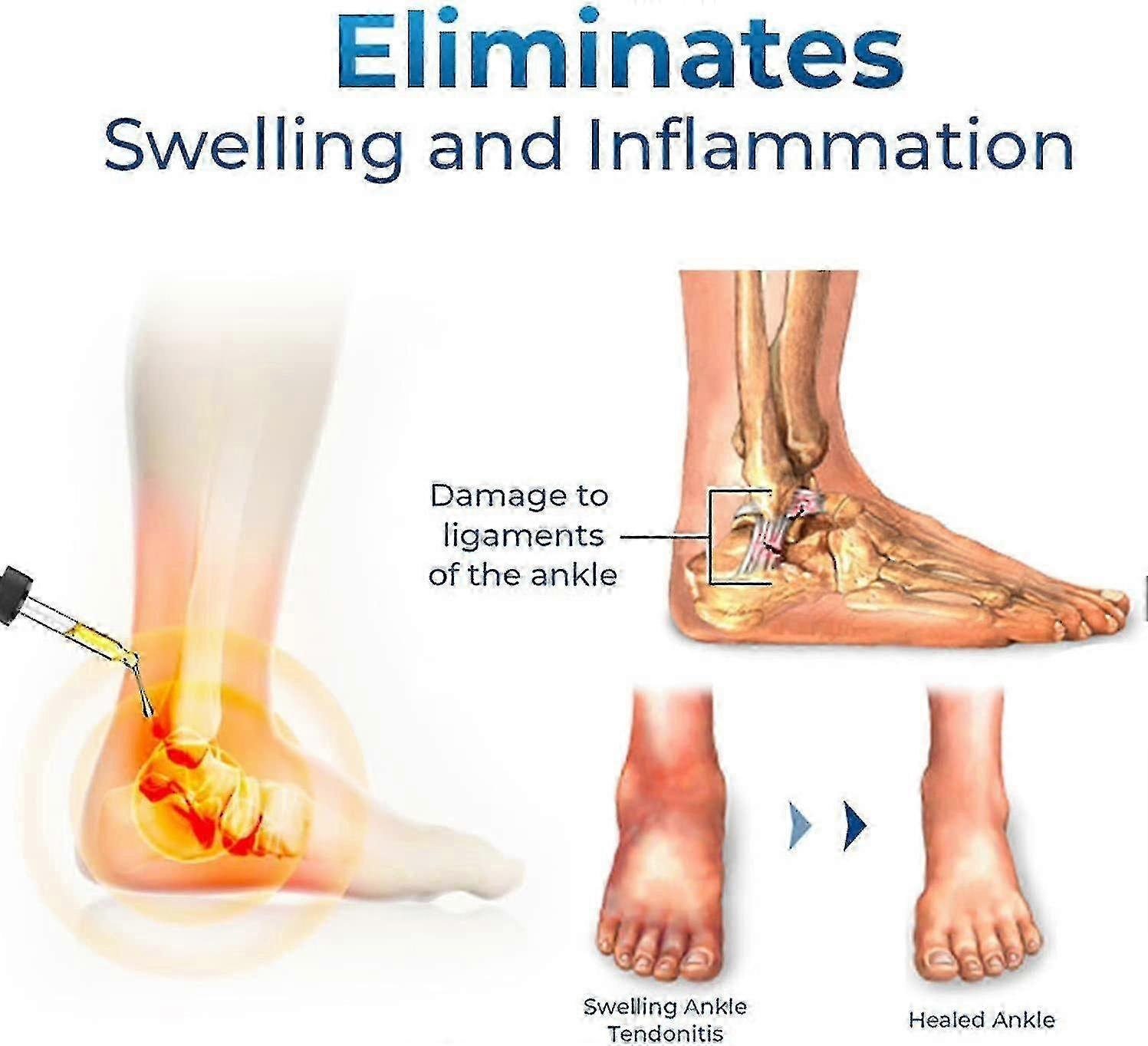Ankle Tendonitis Therapy Oil, German Ankle Tendonitis Therapy Oil, Foot ...