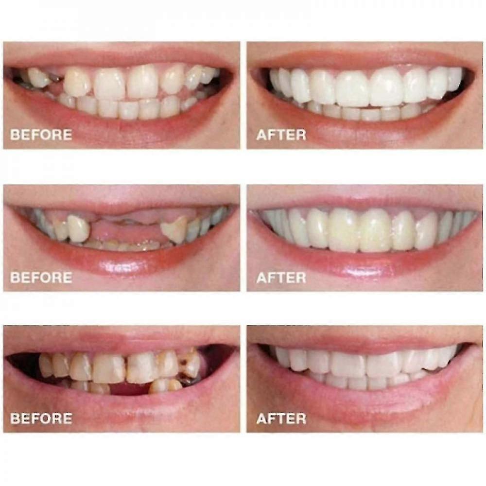 Fake Teeth Cosmetic Denture Veneers for Upper and Lower Jaw Dental ...