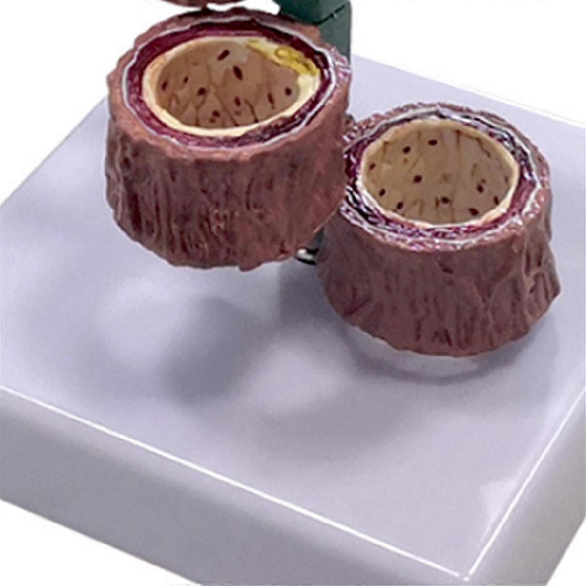 Human Body 4-Piece Artery Model, Anatomical Replica Model, Sclerosis ...