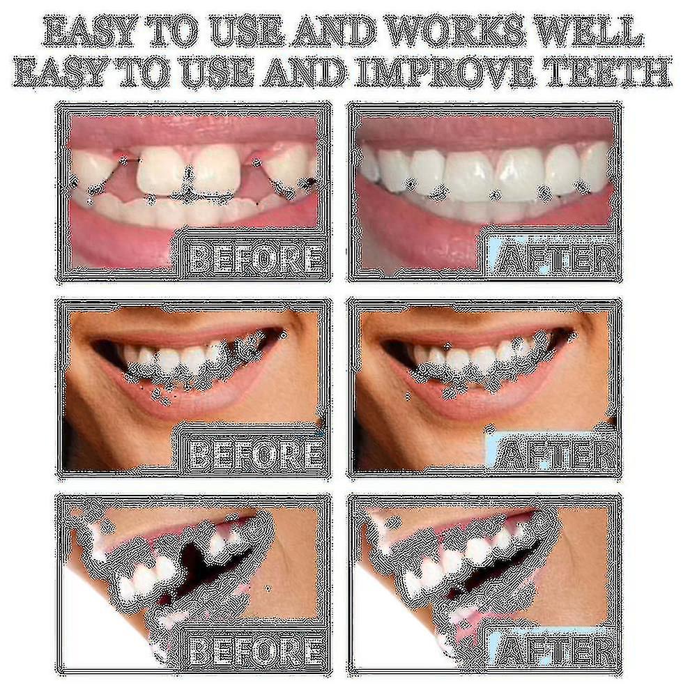 Adjustable Snap-on Dentures, Veneers Denture Braces Plus Denture Cases, Temporary Fillings ...