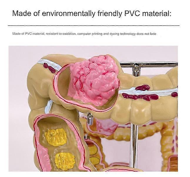 Large Intestine Pathology Model Stomach / Intestine, Human Colon ...