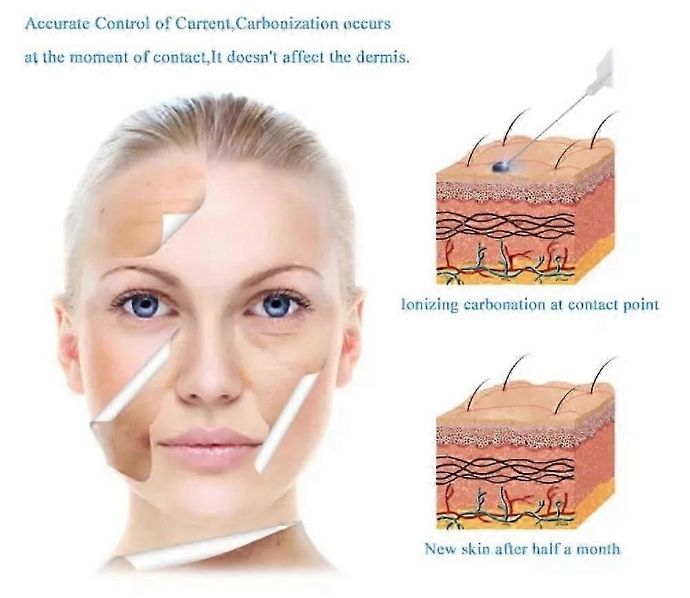 Plasma Pen Eyelid Lift Wrinkle with Needle Free Mole Remover Machine ...